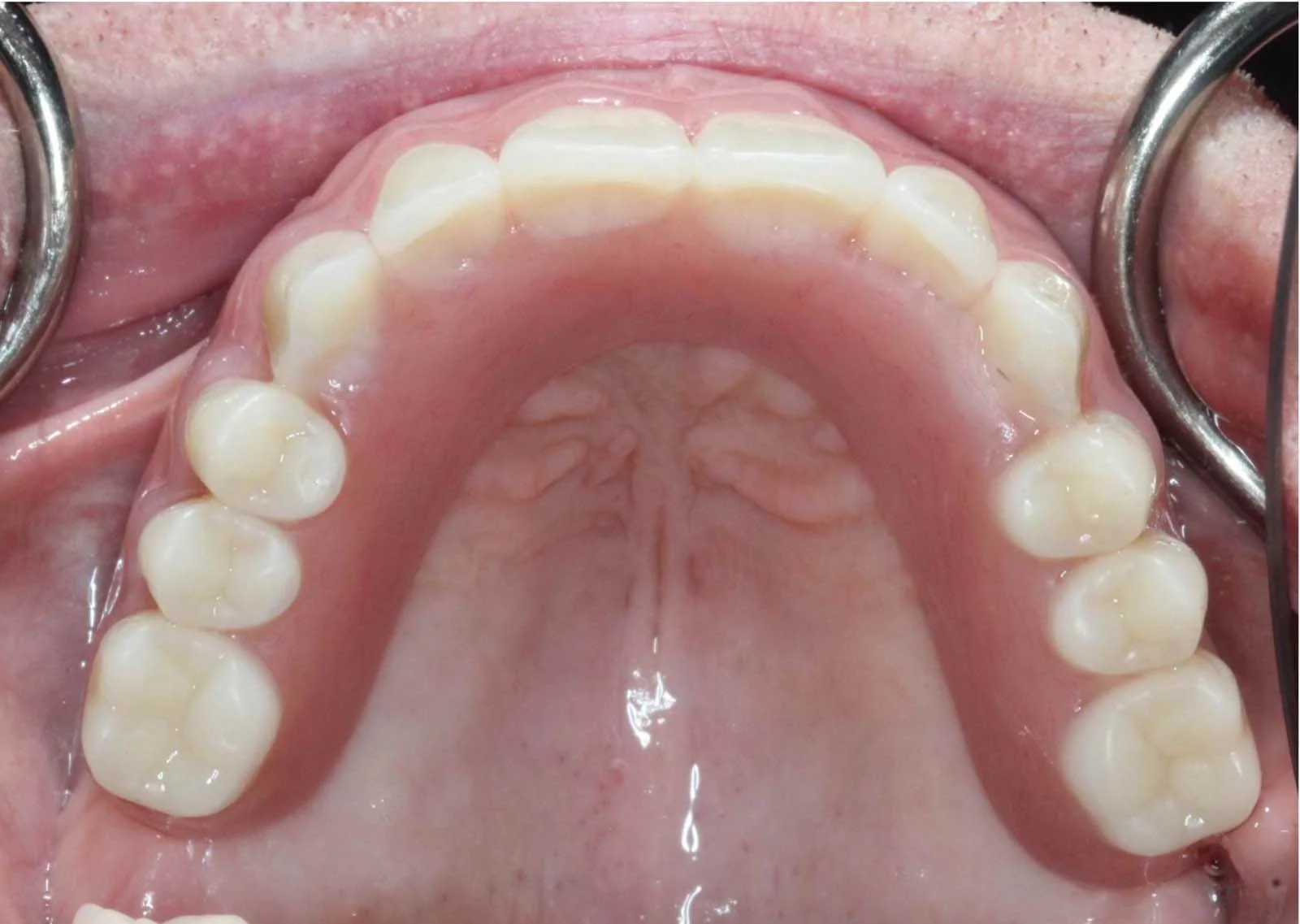 Implant Retained Dentures: Built To Last