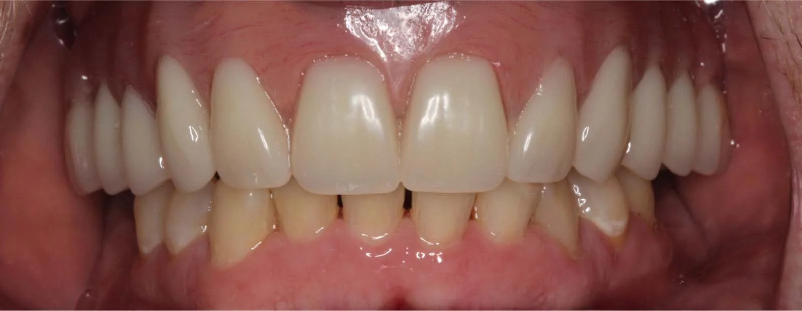 Implant Retained Dentures: Built To Last